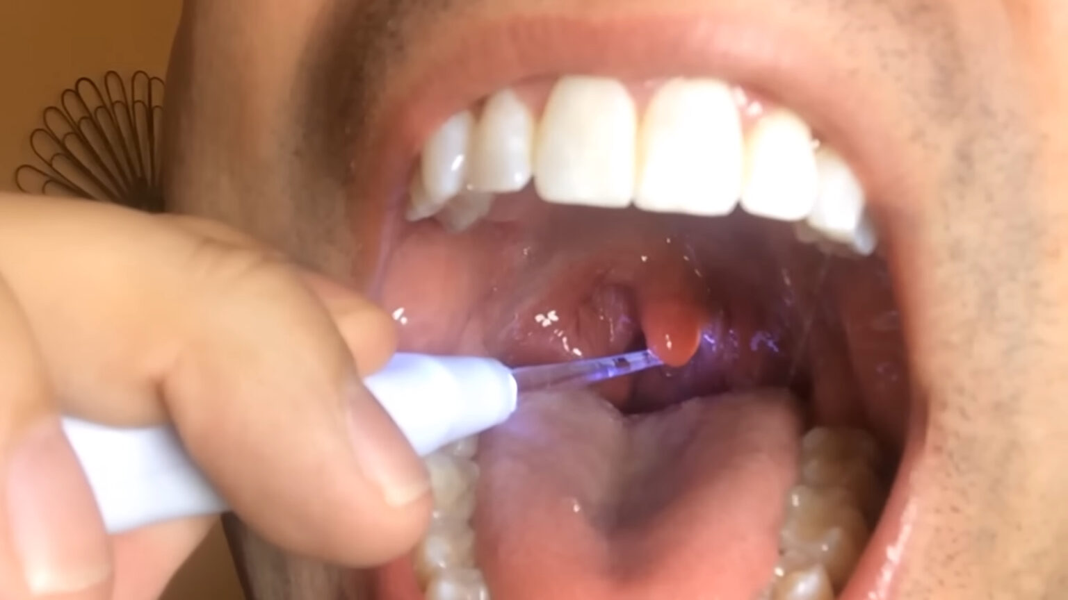 Uvećana resica u grlu - Da li je opasna i kada posetiti lekara?